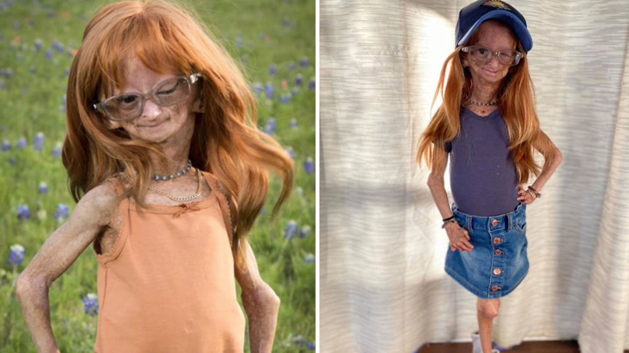 Falleció Adalia Rose, la youtuber que padecía la enfermedad que inspiró ...